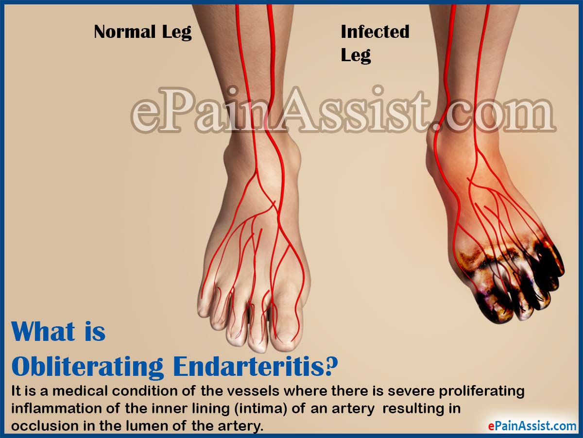 What is Obliterating Endarteritis|Causes|Symptoms|Treatment