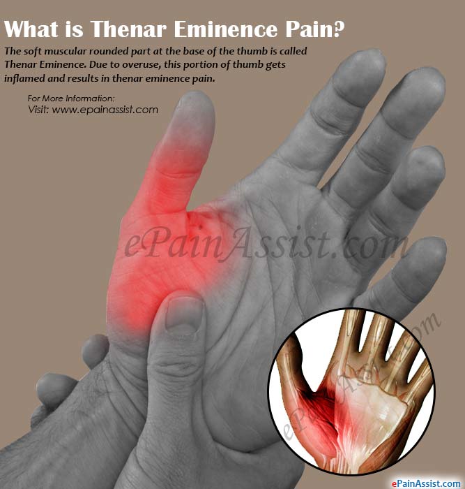 Thenar Eminence Pain|Causes|Symptoms|Treatment|Pathophysiology ...