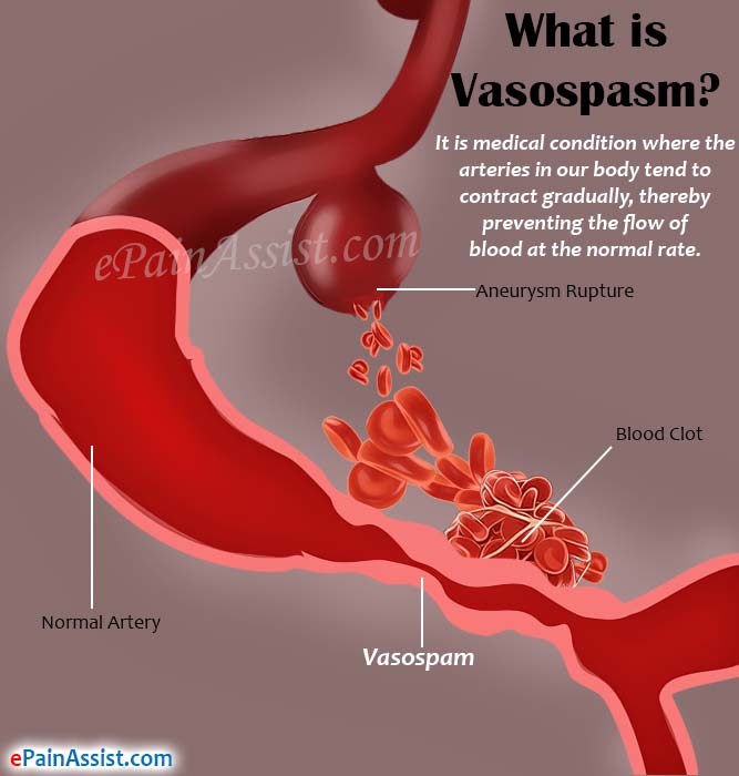 What is Vasospasm|Causes|Symptoms|Treatment|Diagnosis