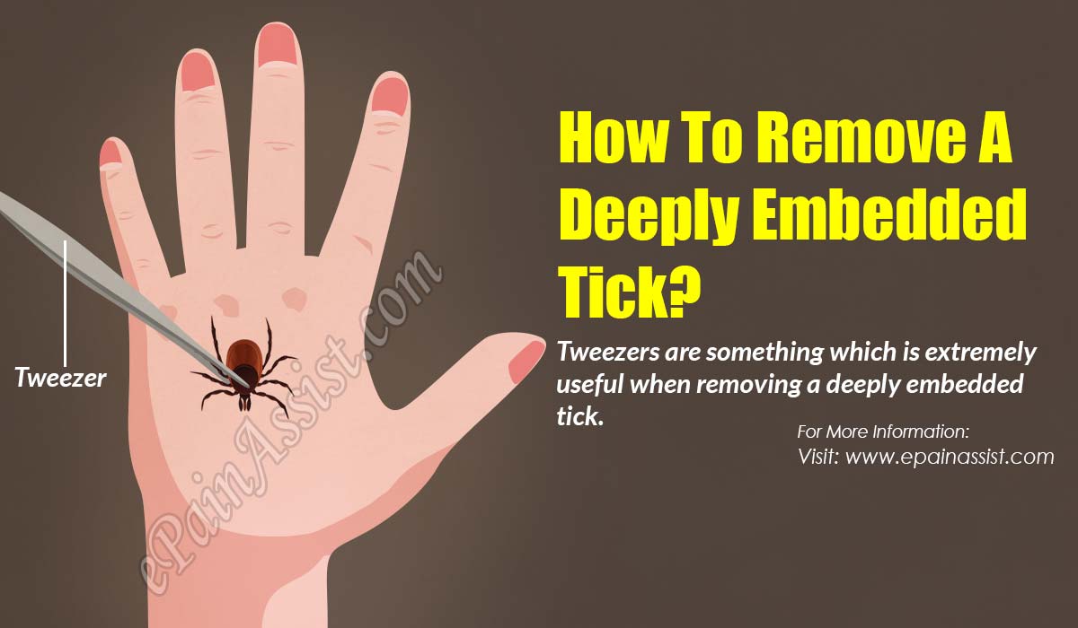 How To Remove A Deeply Embedded Tick 