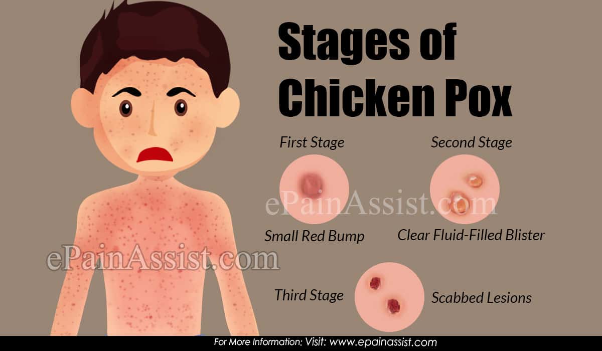 NCLEX PED NCLEX PED