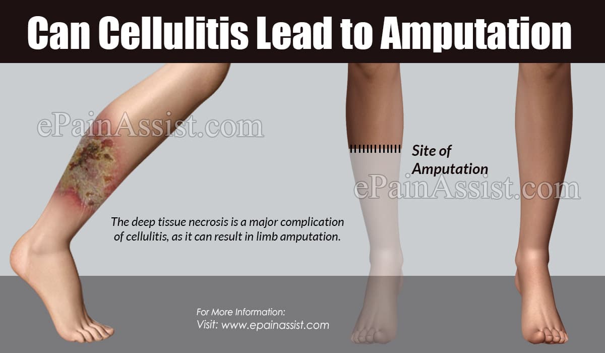 Can Cellulitis Lead To Amputation Can Cellulitis Lead To Amputation