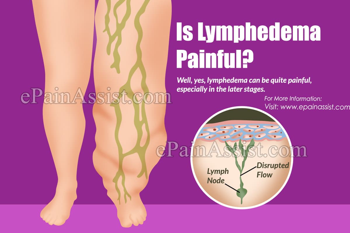 Is Lymphedema Painful Is Lymphedema Painful
