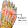 What Is The Major Cause Of Neuroma?