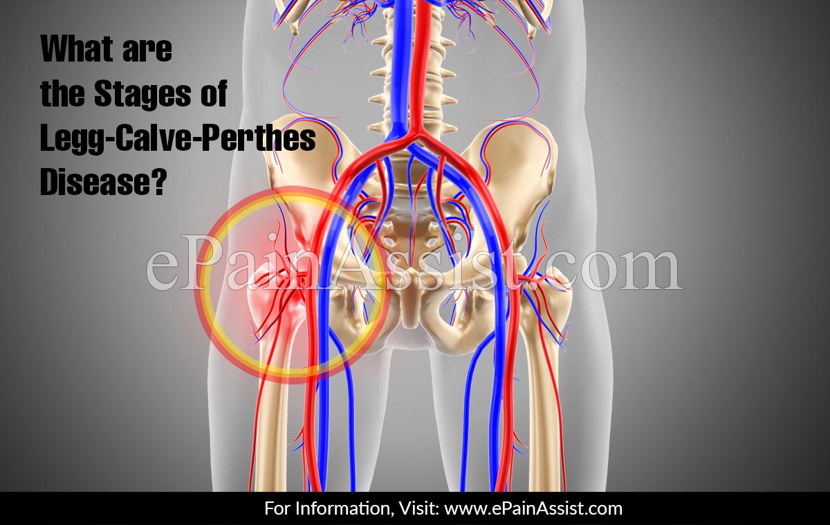 What Are The Stages Of Legg Calve Perthes Disease 