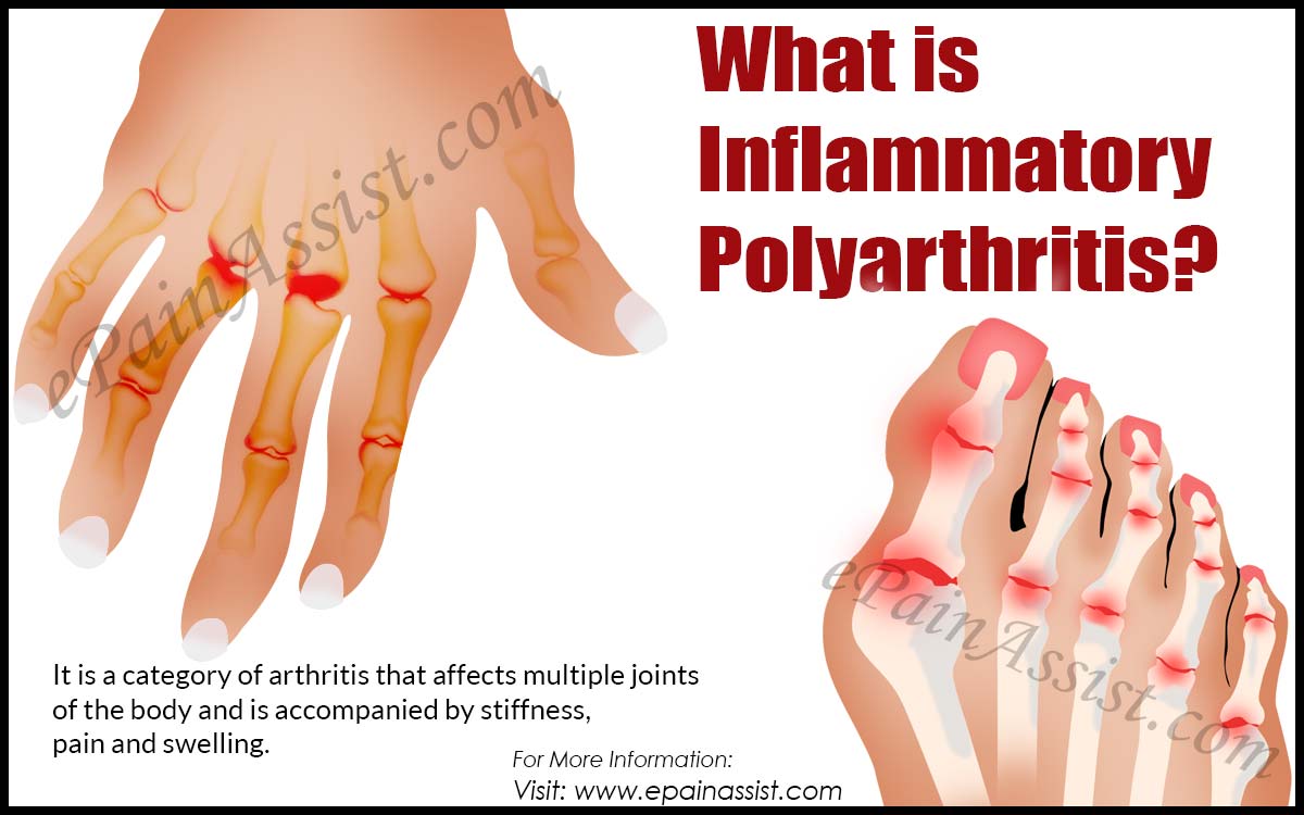 What Is Inflammatory Polyarthritis Causes Signs Symptoms Treatment What Is Inflammatory Polyarthritis Causes Signs Symptoms Treatment