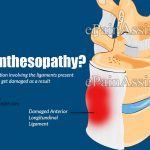 What Causes Hip Fat & Natural Ways to Reduce Fat Around Hips