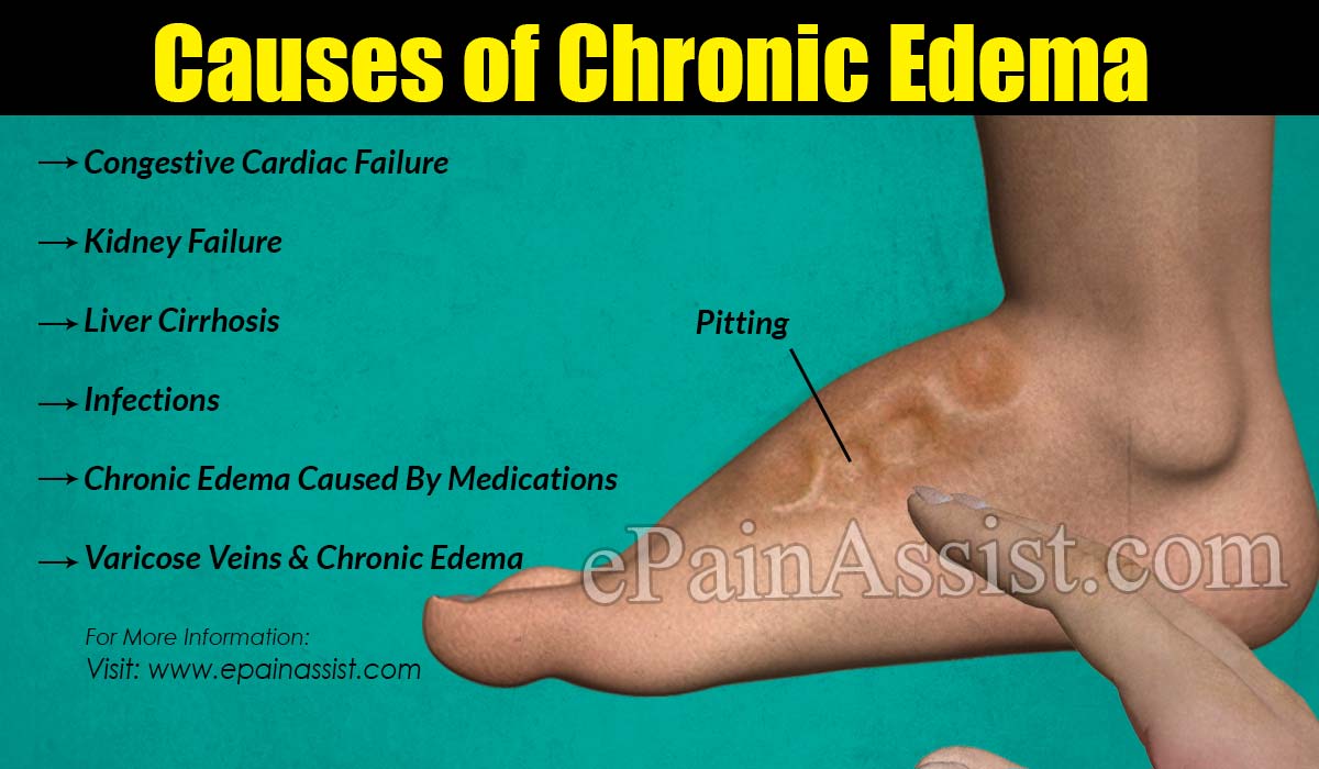 Causes Of Chronic Edema Its Treatment Complications