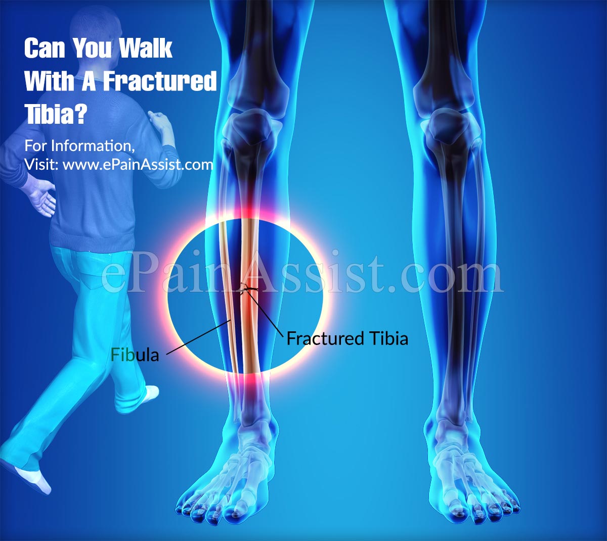 Can You Walk With A Fractured Tibia 