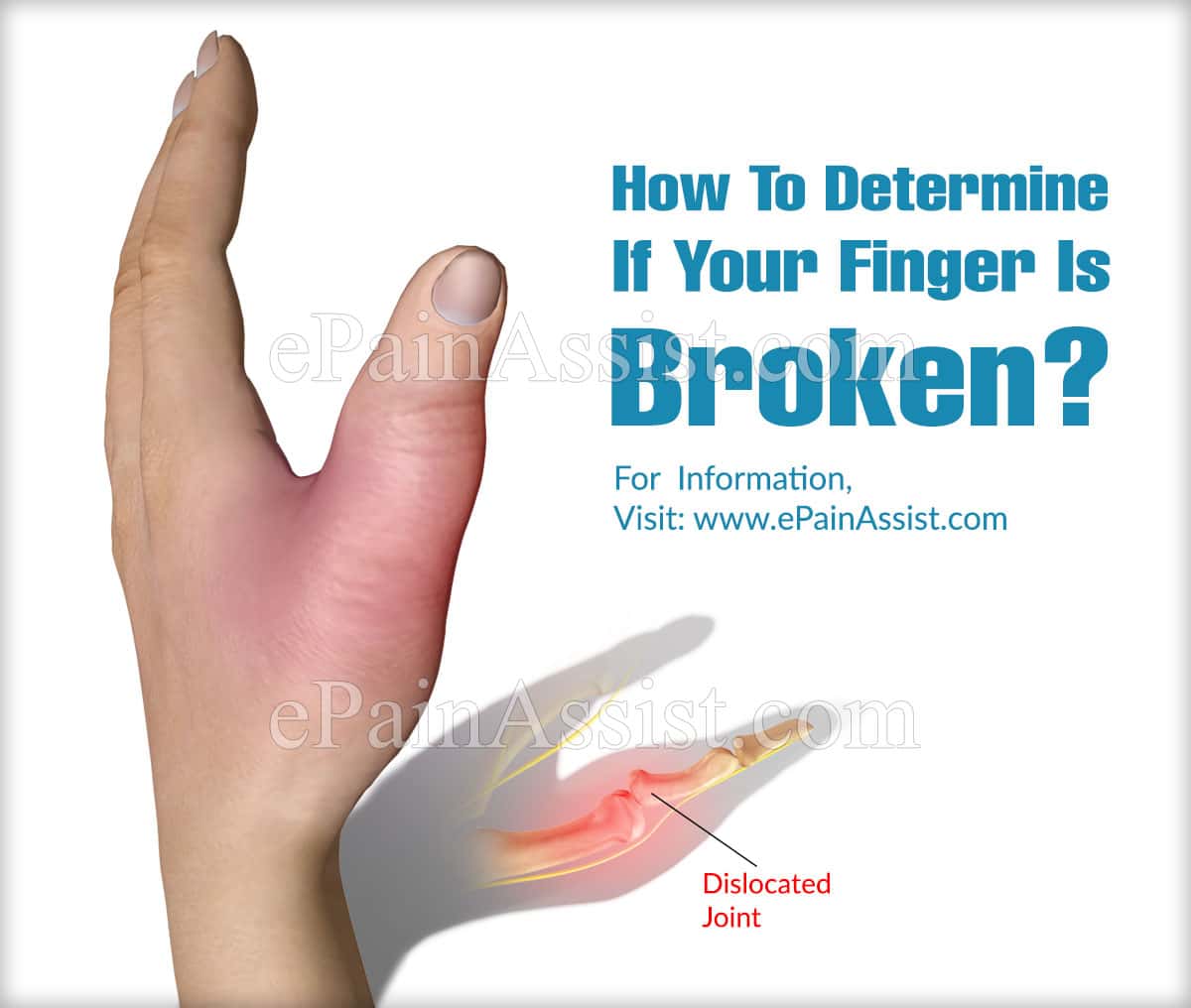 How To Determine If Your Finger Is Broken Ways To Manage A Broken Finger