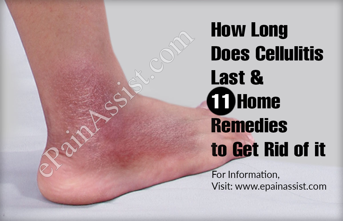How Long Does Cellulitis Last 11 Home Remedies To Get Rid Of It How Long Does Cellulitis Last 11 Home Remedies To Get Rid Of It