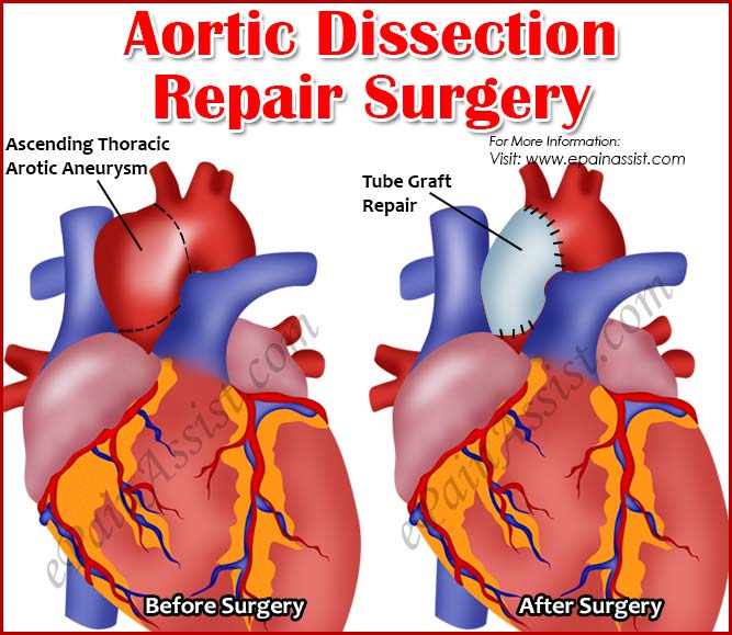 Aortic Dissection Repair Surgery Types Recovery Period Aortic Dissection Repair Surgery Types Recovery Period