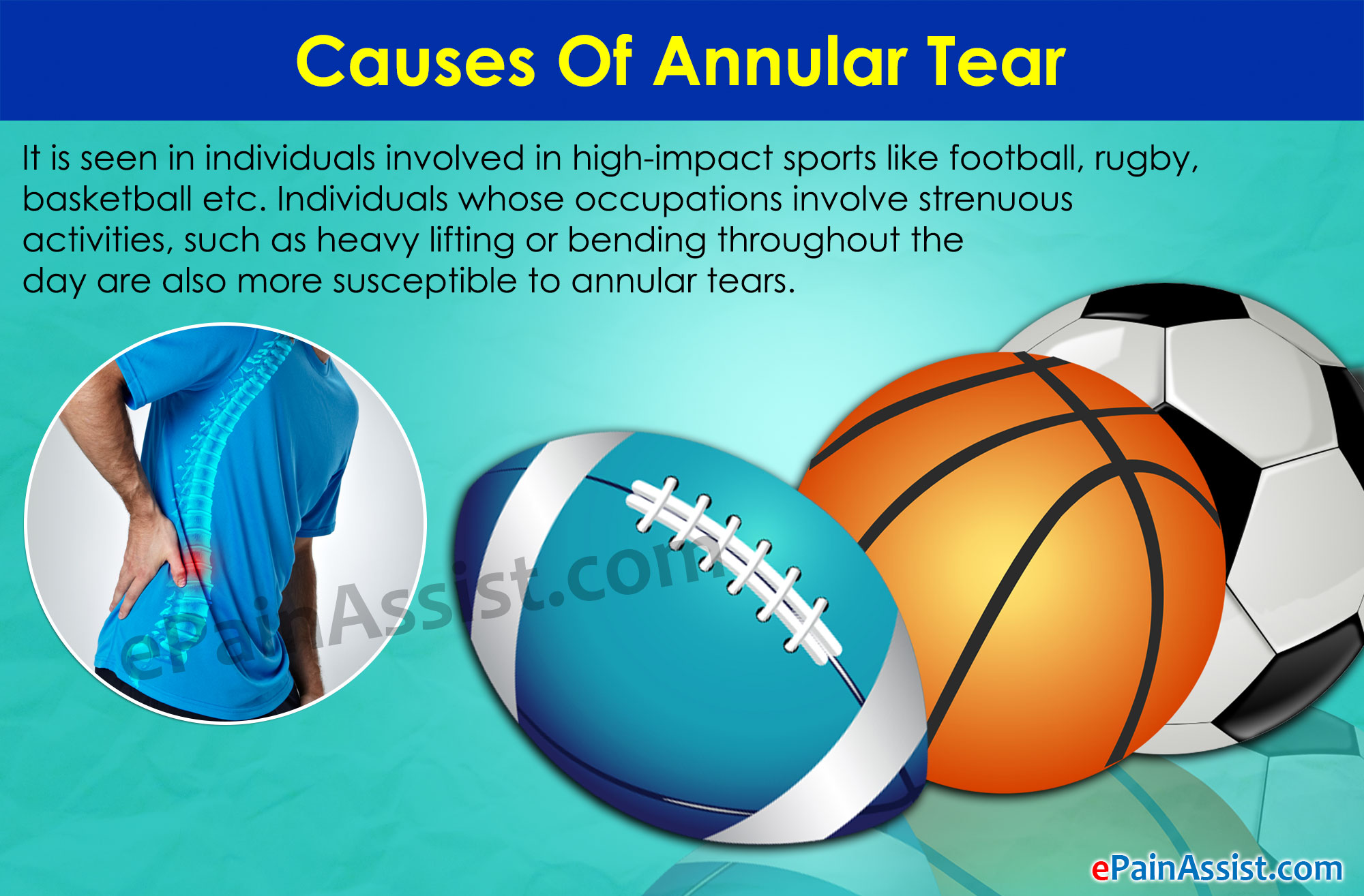 Annular Tear Treatment Healing Time Exercises Symptoms