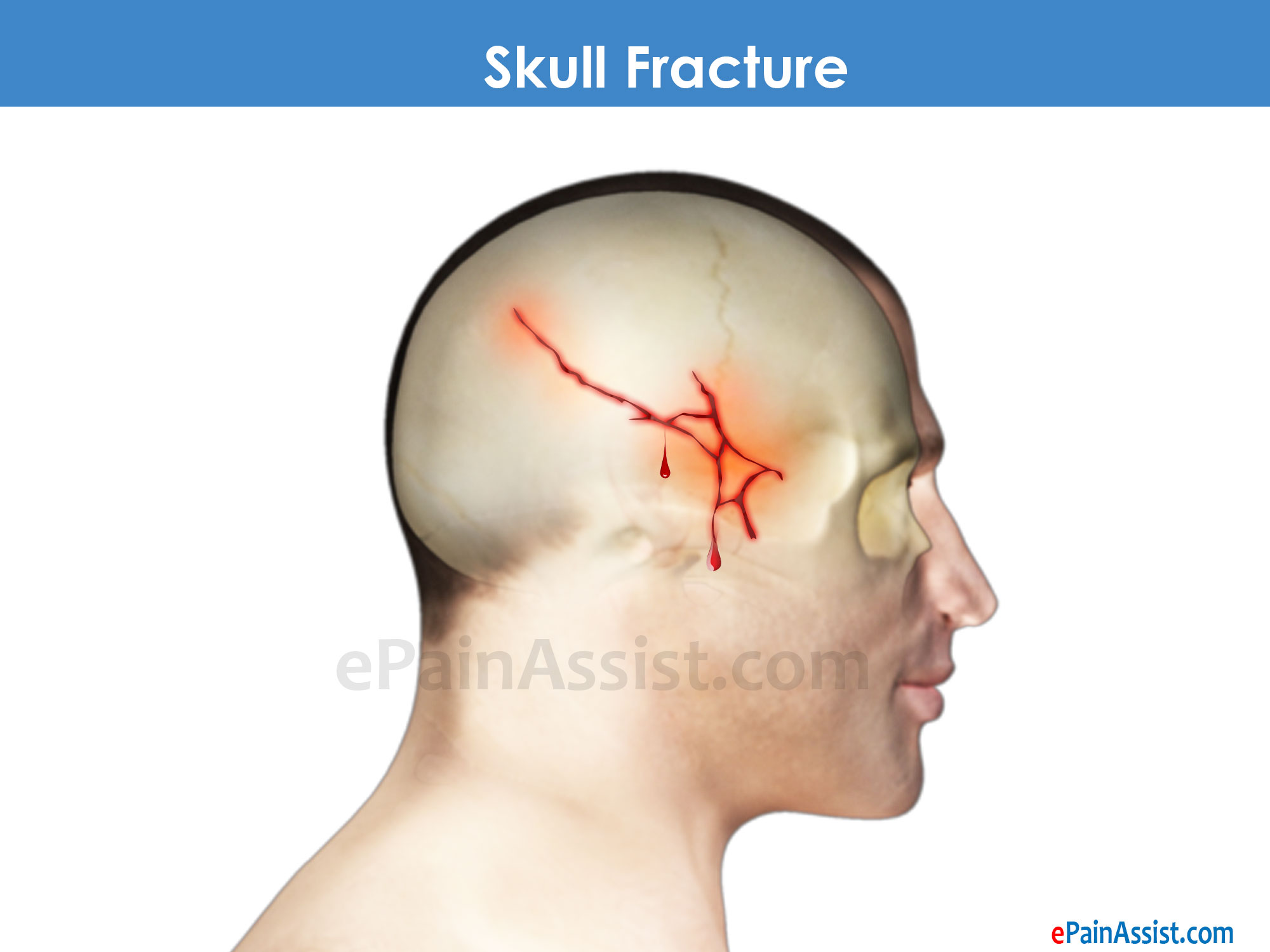 Types Of Skull Fracture WeareJuli