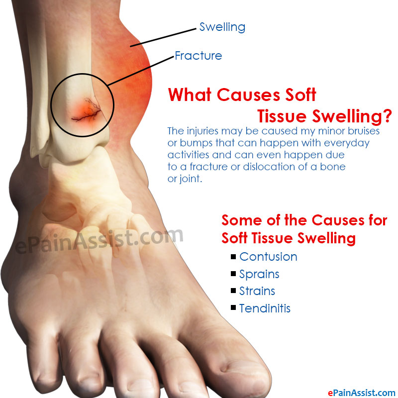 What Can Cause Soft Tissue Swelling And How Is It Treated 