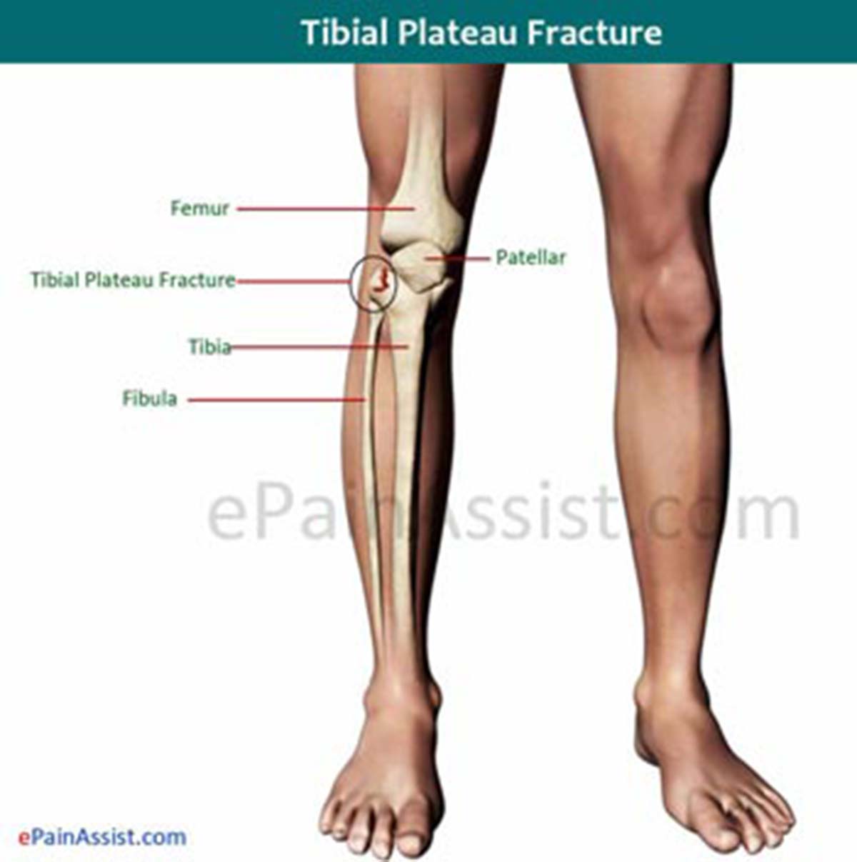 Contusion Lateral Tibial Plateau Icd 10