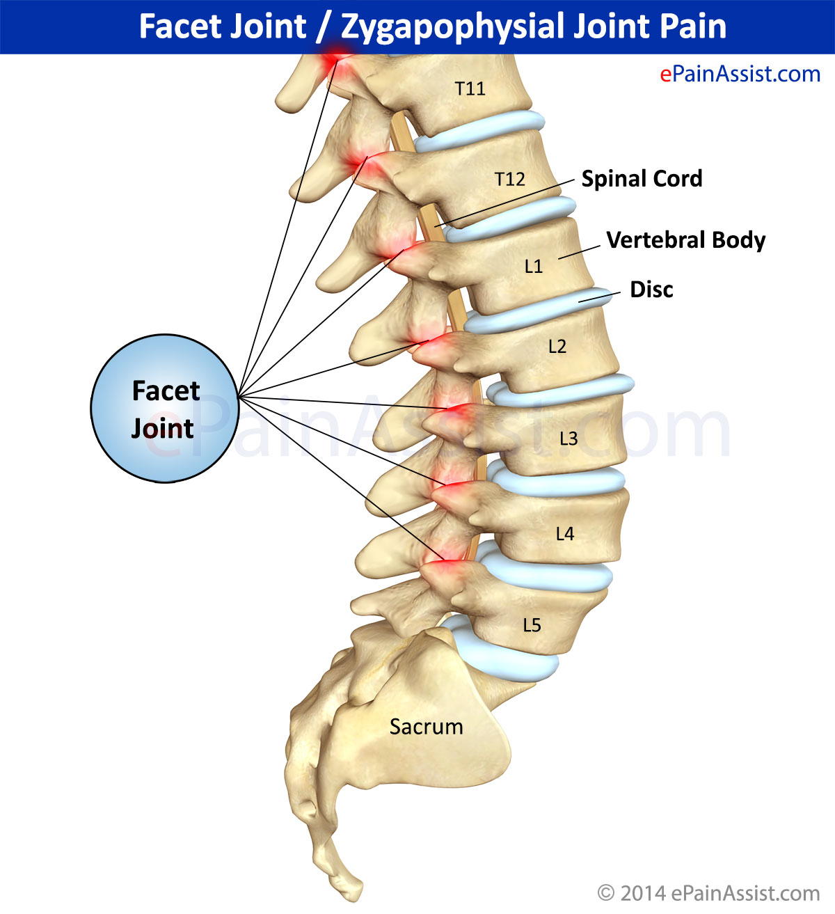 Facet Joint Or Zygapophysial Joint Pain Treatment Causes Symptoms Facet Joint Or Zygapophysial Joint Pain Treatment Causes Symptoms