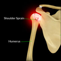 Shoulder Injuries Information Center: Biceps Tendon Rupture, Broken ...