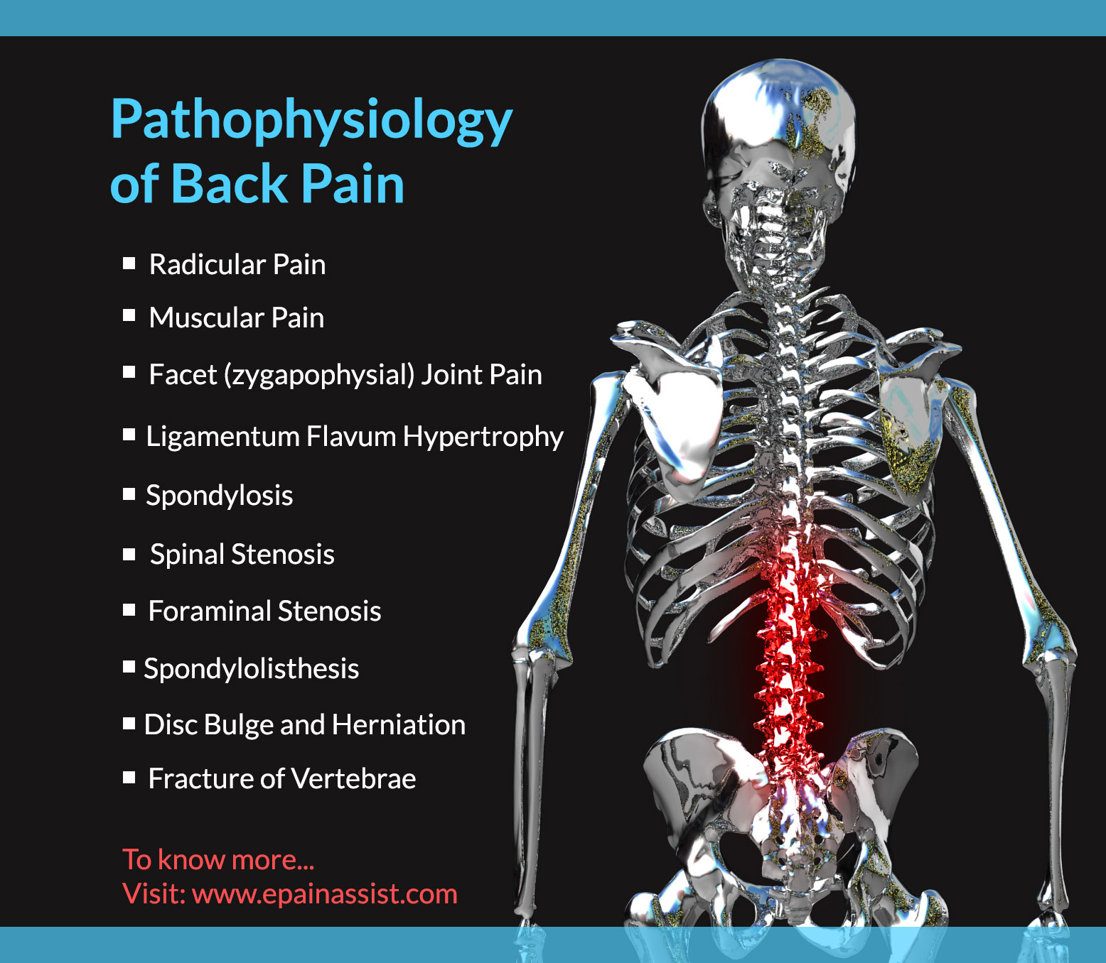 Pathophysiology Of Back Pain Or Backache Radicular Muscular Facet Pathophysiology Of Back Pain Or Backache Radicular Muscular Facet