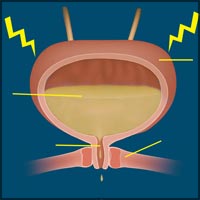 Urinary Bladder Information Center: Bladder Pain, Bladder Sphincter ...