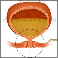 Urinary Bladder Information Center: Bladder Pain, Bladder Sphincter ...