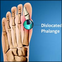 Foot Pain Information Center: Foot Cramps, Foot Joint Dislocation ...