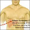 Liver Disorders Information Center: Liver Cancer, Alagille Syndrome ...