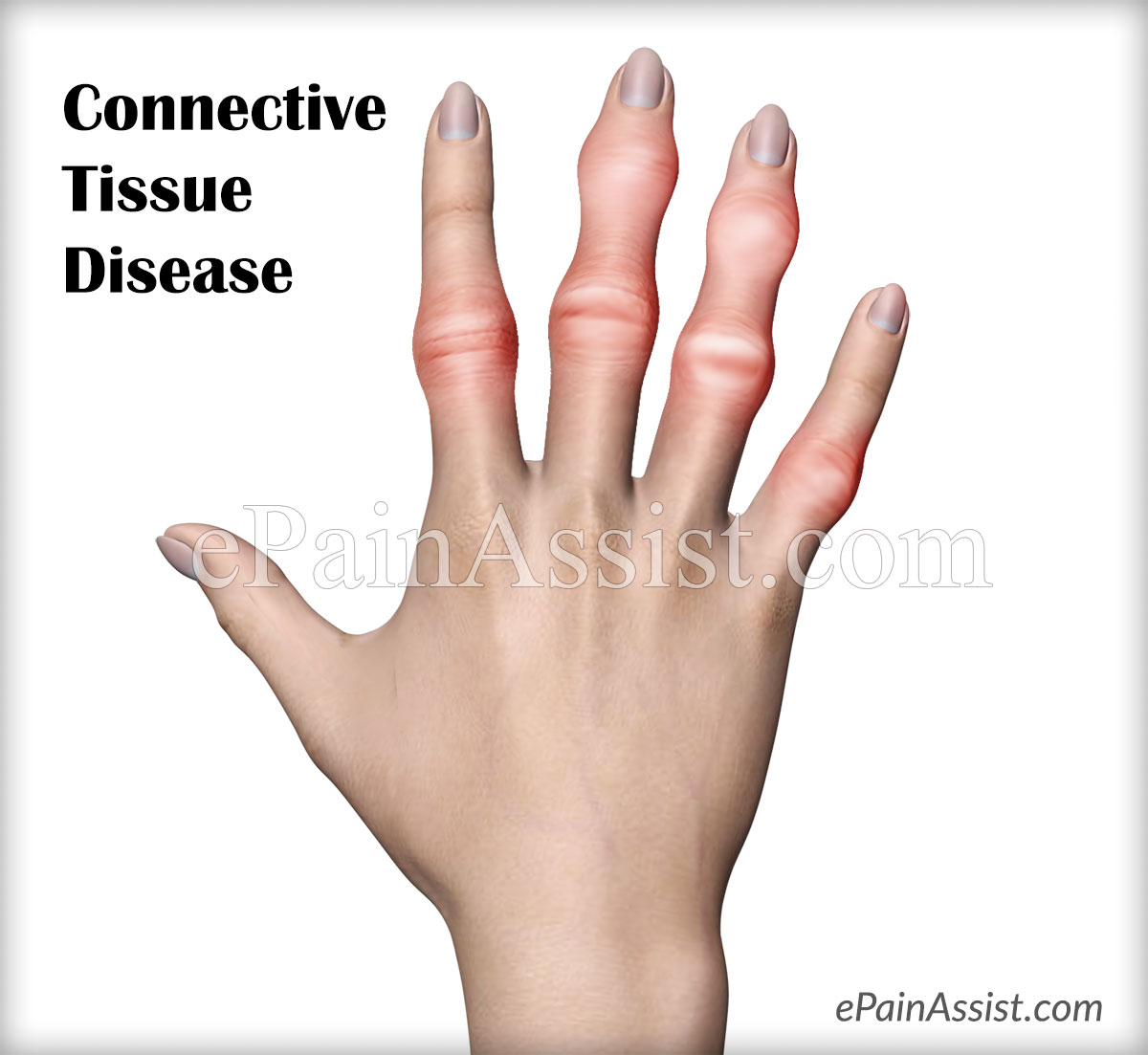 Connective Tissue Disease Types Symptom Treatment Causes Prevention
