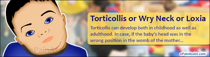 Torticollis or Wry Neck or Loxia|Causes|Symptoms|Diagnosis|Treatment ...