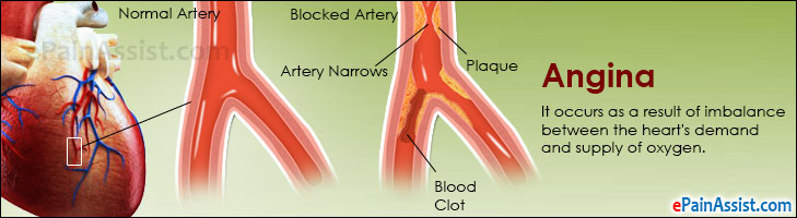 Angina Types Causes Symptoms Treatment Beta Calcium Channel Blockers 