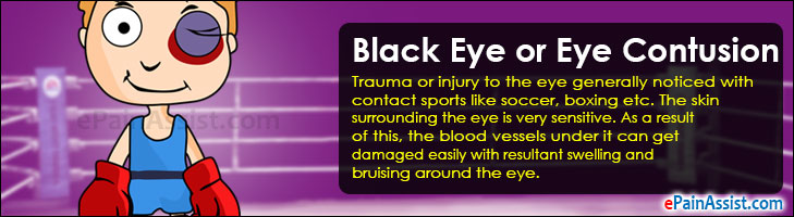Black Eye or Eye Contusion|Treatment|Causes|Symptoms