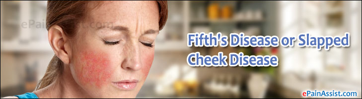 Fifth’s Disease or Slapped Cheek Disease or Parvovirus Infection|Causes ...