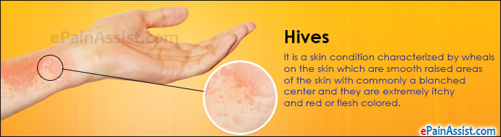 Hives & Angioedema: Treatment, Home Remedies, Prevention, Causes