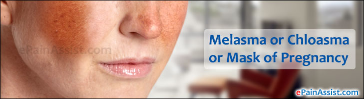 Melasma or Chloasma or Mask of Pregnancy|Causes|Location|Types ...