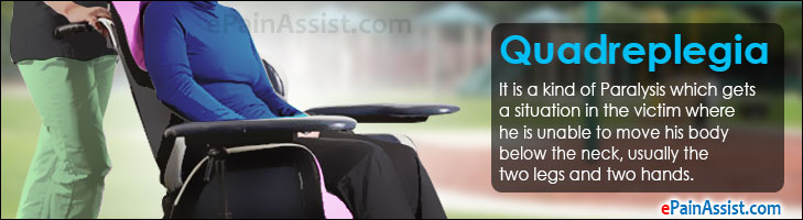 Quadriplegia Tetraplegia Definition Causes Symptoms