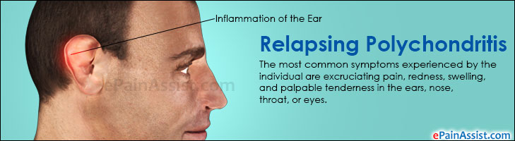 Relapsing Polychondritis: Treatment, Symptoms, Causes