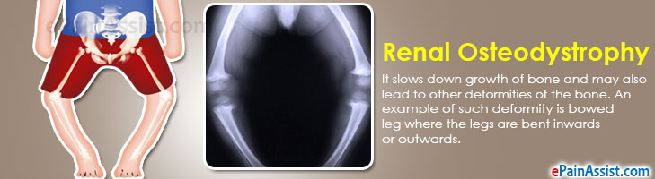 Renal Osteodystrophy: Definition, Treatment, Causes, Symptoms, Diagnosis