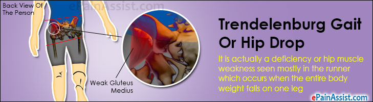 Cause Of Trendelenburg Gait