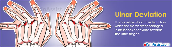 Ulnar Deviation And Ulnar Drift Definition And Causes