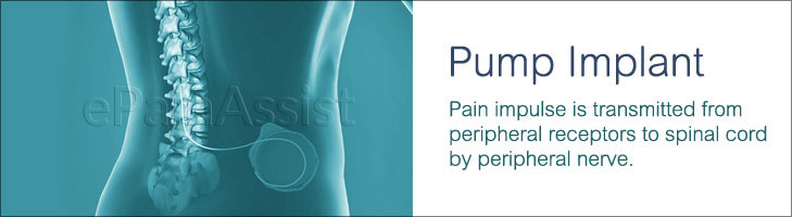 Intrathecal Pain Pump For Chronic Pain Treatment