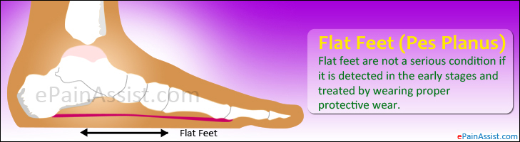 Flat Feet or Pes Planus or Fallen Arches|Causes|Symptoms|Treatment