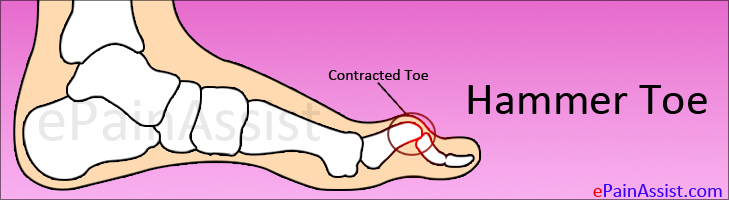Hammer Toe or Contracted Toe|Causes|Treatment | How Does Hammer Toe ...