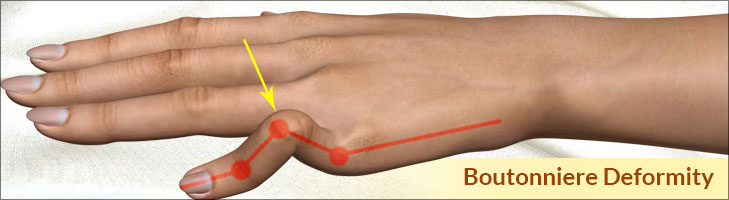 Boutonniere Deformity Signs And Symptoms – EHTN