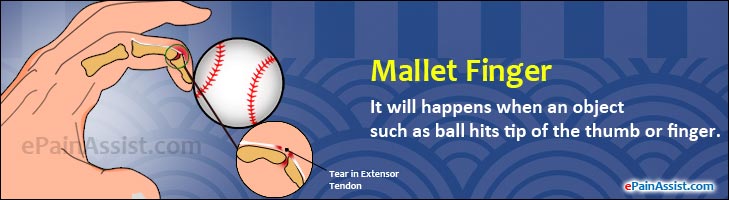 Mallet Finger or Baseball Finger|Causes|Symptoms|Treatment|Investigations