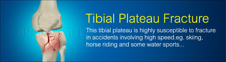 What is Fractured Tibial Plateau or Tibial Plateau Fracture?