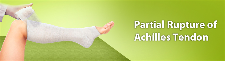 Partial Rupture Of Achilles Tendon Symptoms Treatment Exercises Sports Partial Rupture Of Achilles Tendon Symptoms Treatment Exercises Sports