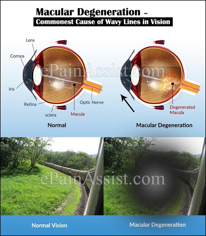 What Can Cause Wavy Lines In Vision How Is It Treated 
