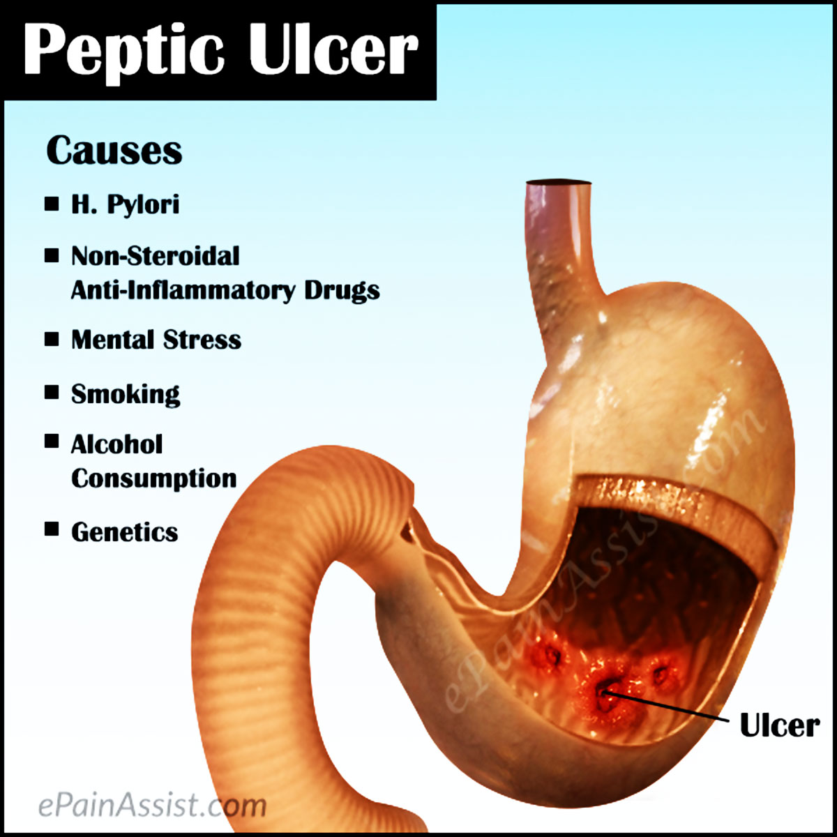Types of ulcer causes and treatment