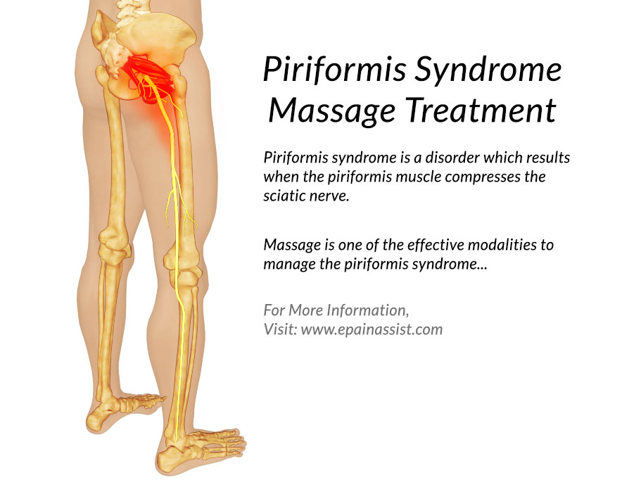 Piriformis Syndrome Massage Treatment Piriformis Muscle Massage