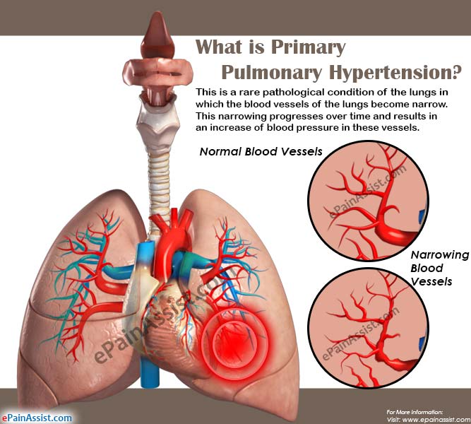 Primary Pulmonary Hypertension Treatment Symptoms Primary Pulmonary Hypertension Treatment Symptoms